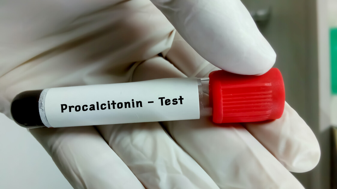 Procalcitonin (PCT) jelentése a laborleleten | Házipatika